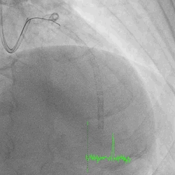 OCT-Guided Contrast Excimer Laser for Under-Expanded Stent: Case ...