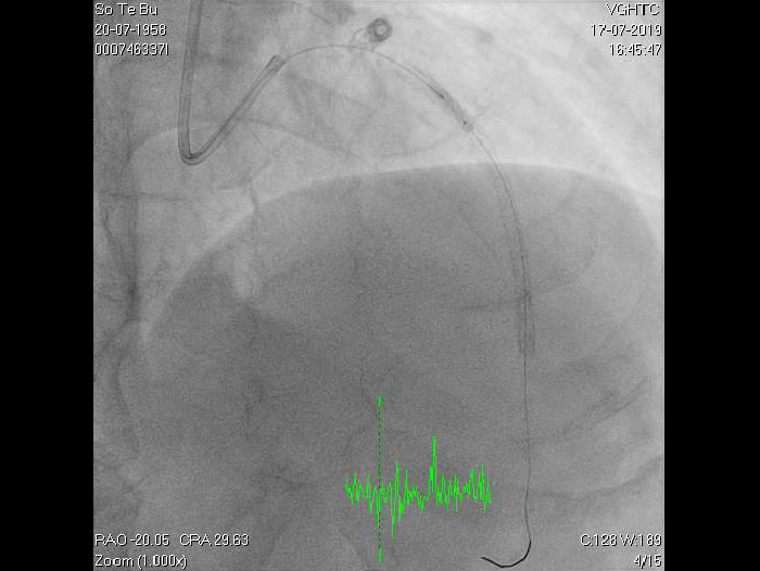 OCT-Guided Contrast Excimer Laser for Under-Expanded Stent: Case ...