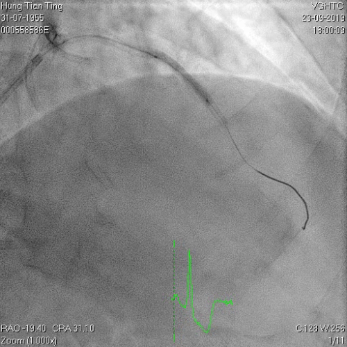 OCT-Guided Contrast Excimer Laser for Under-Expanded Stent: Case ...
